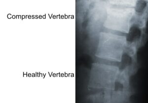Kyphotic or Osteoporosis Posture | Postural Dysfunction