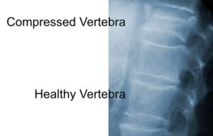 Kyphotic or Osteoporosis Posture | Postural Dysfunction