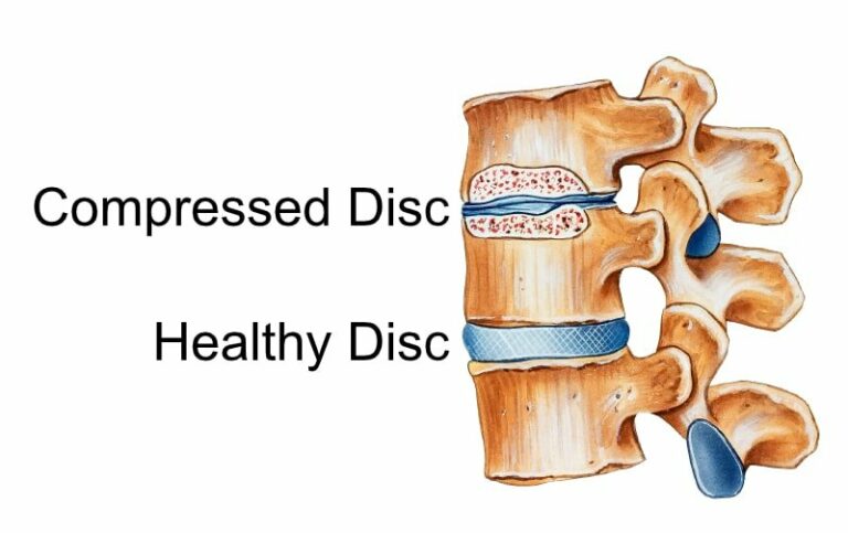 Kyphotic or Osteoporosis Posture | Postural Dysfunction