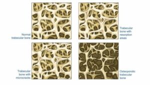 Bone Quality Index, Bone Structure and Osteoporosis